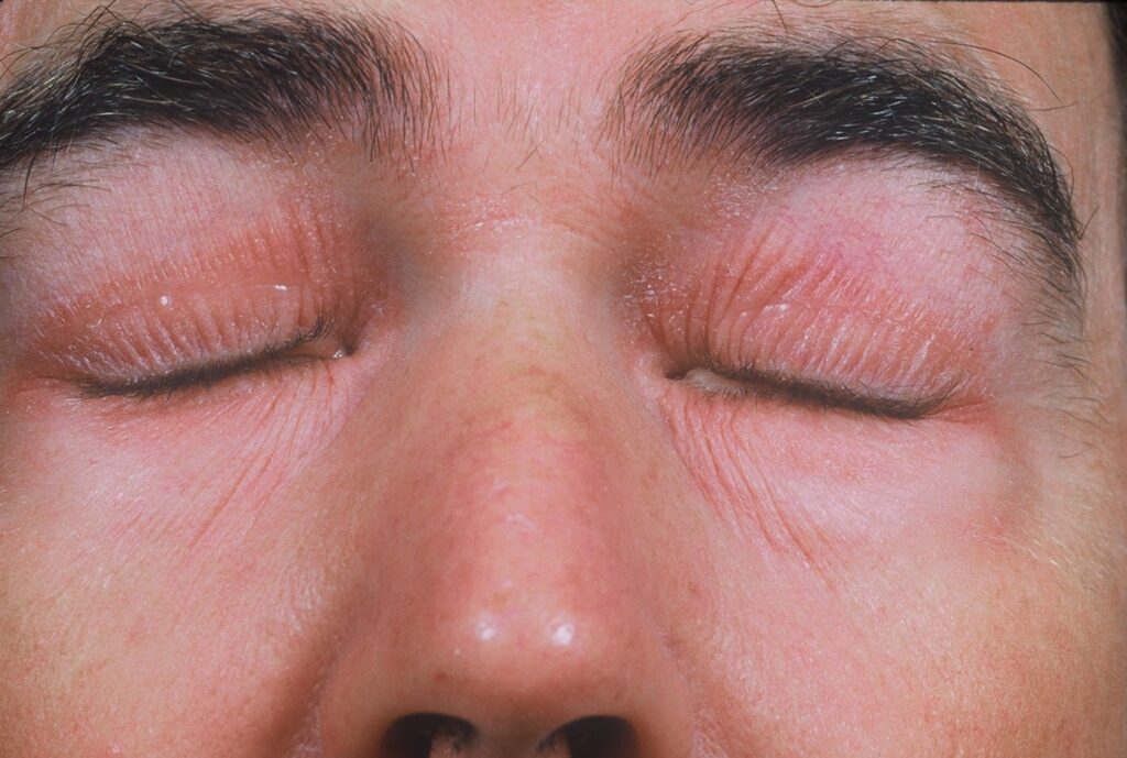 Heliotrope Rash (Dermatomyositis) – RheumExam Atlas