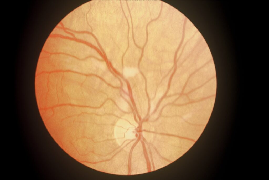 Extra-articular – RheumExam Atlas