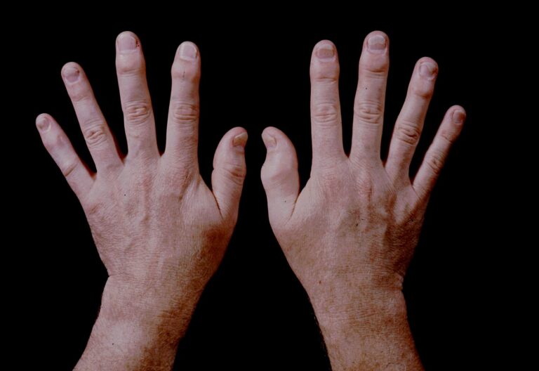 Psoriatic Arthritis in the Hand – RheumExam Atlas