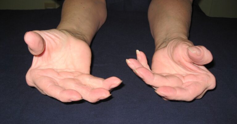 Typical Ulnar Deviation of Rheumatoid Arthritis in the Hand (Supination ...